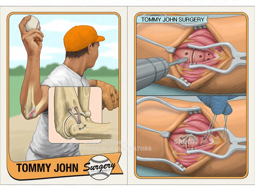 Tommy John & Elbow Injury Research - TopVelocity